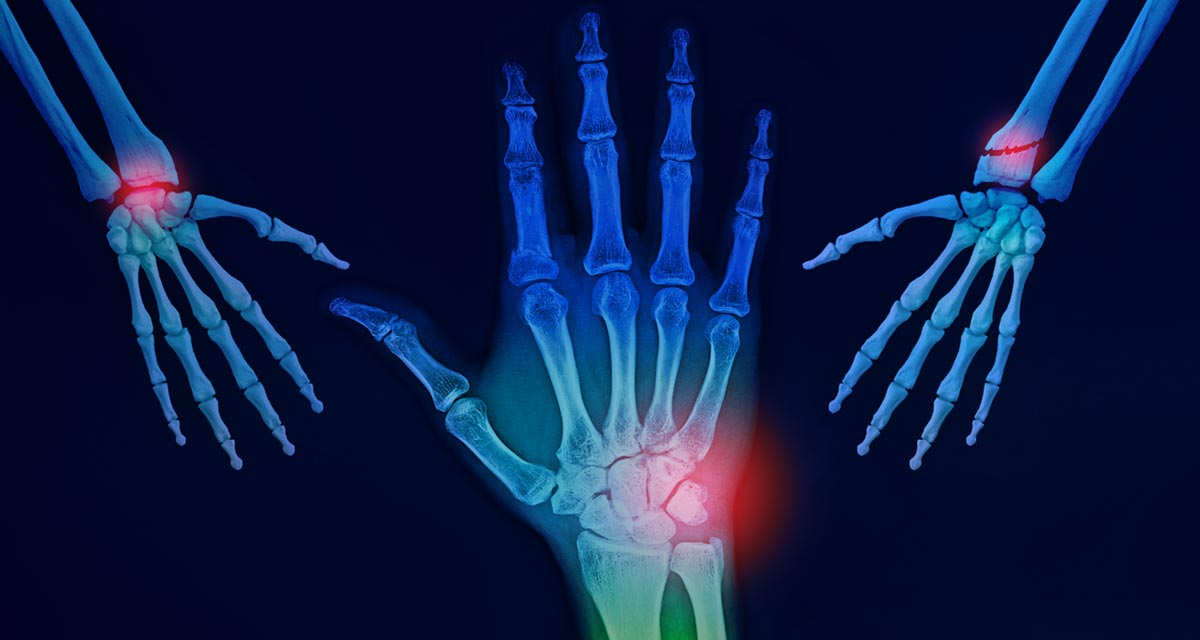 Dolor de Rodilla: Causas, Tratamientos y Síntomas
